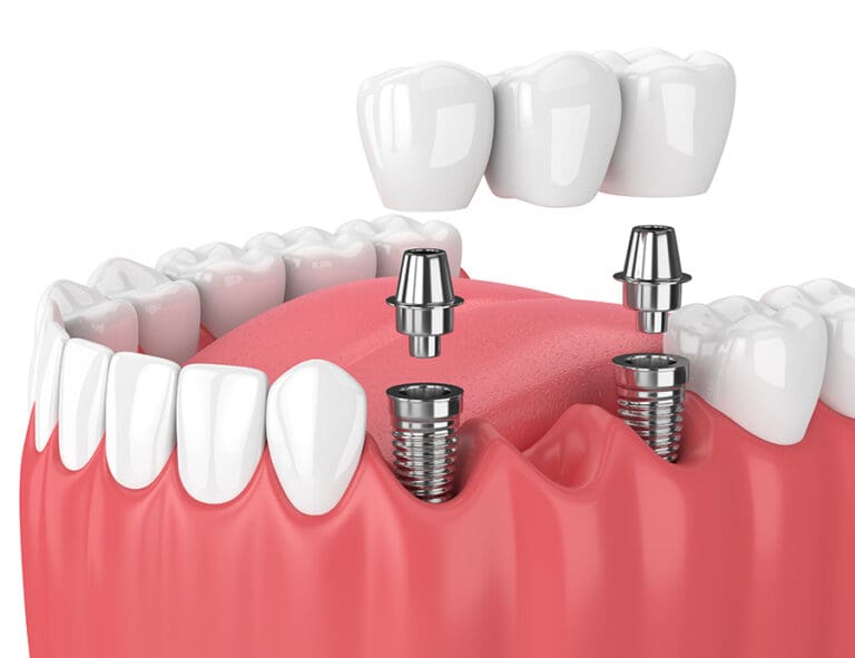 Full mouth dental implants | Oral Surgeon in Vaughan ON | Concord Oral ...
