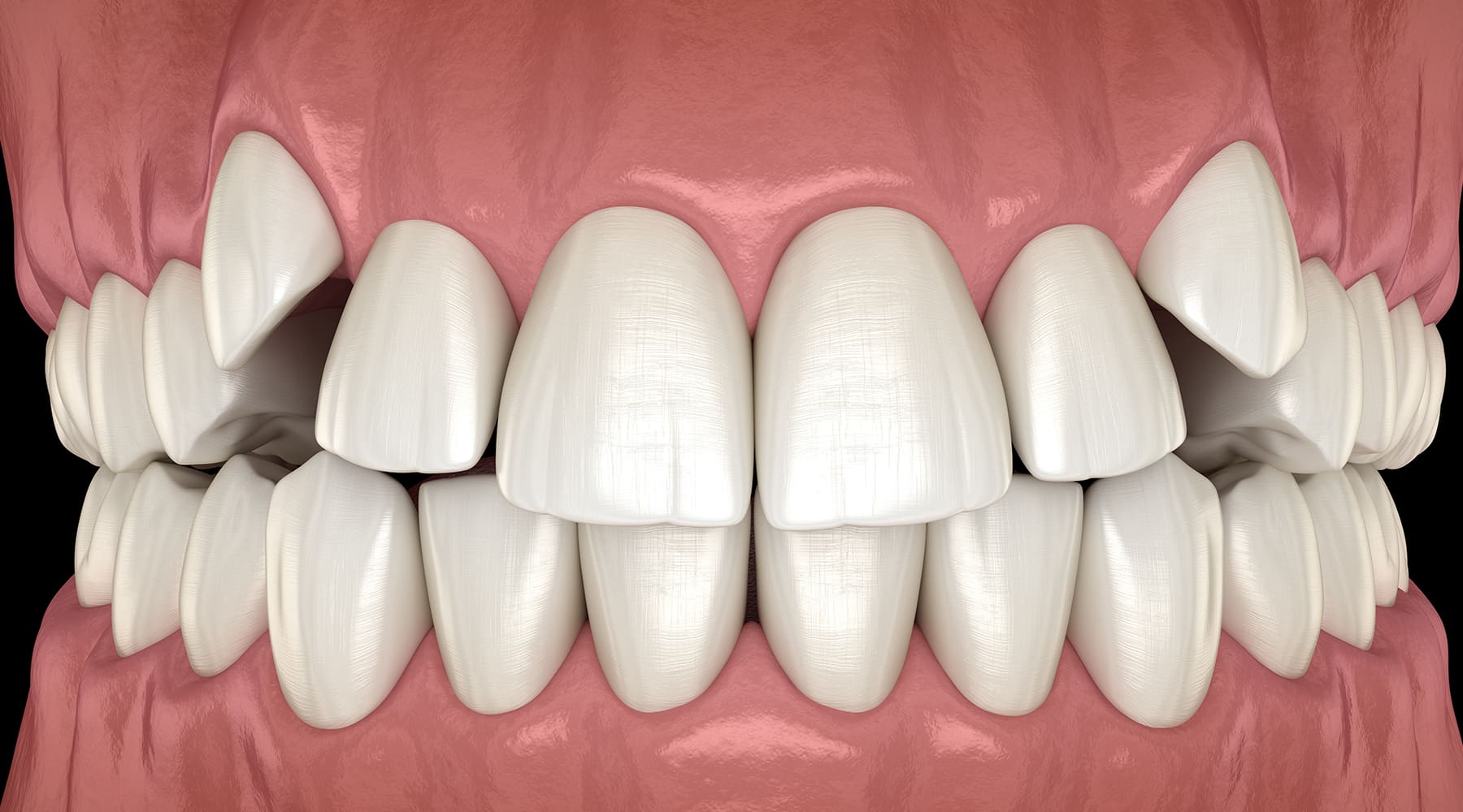 Impacted canines | Oral surgeon in Vaughan ON | Concord Oral Surgery