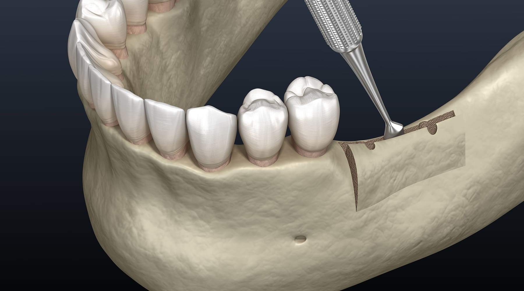 Ridge augmentation | Bone graft | Concord Oral Surgery