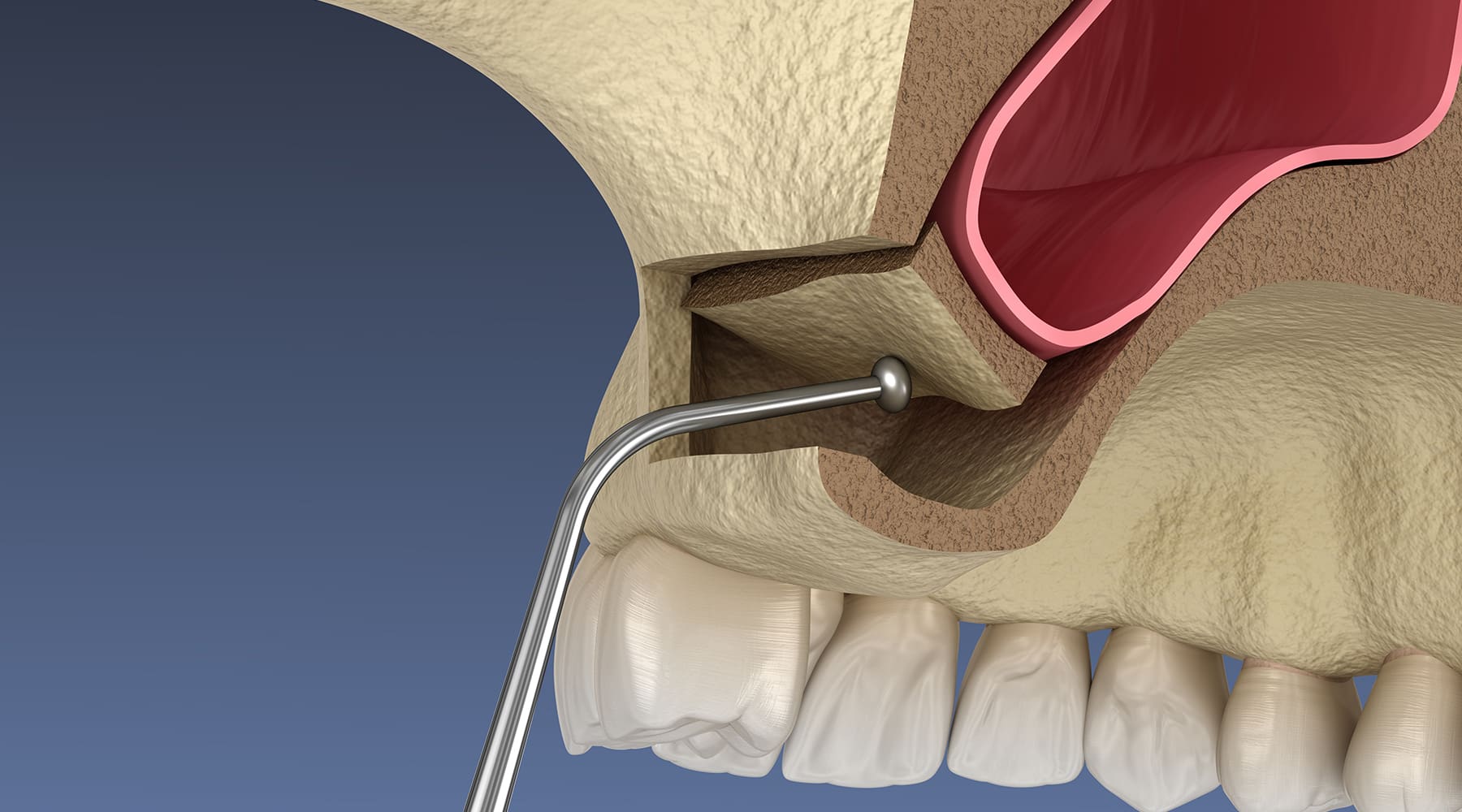 Sinus lift | sinus augmentation | Concord Oral Surgery
