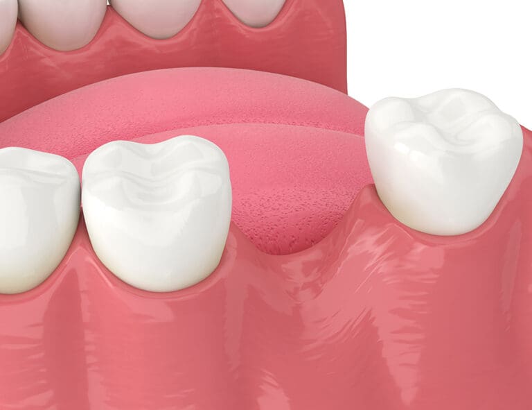 Socket preservation | Bone graft | Concord Oral Surgery